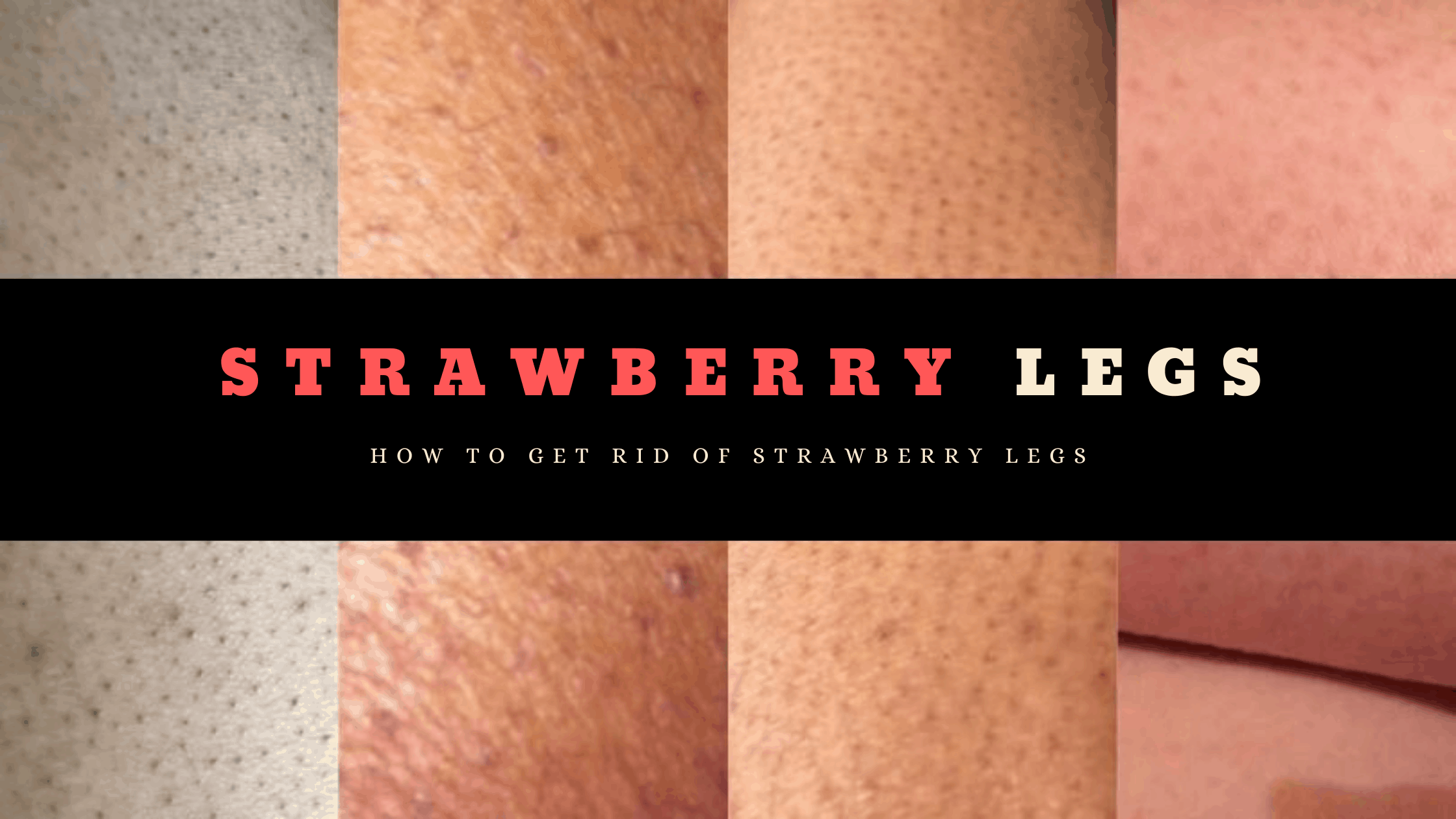 Strawberry Legs Treatment: 3 Efective Remedies To Cure Comedones